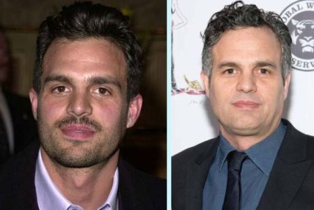 15 Celebrities with Hair Transplants – Before & After